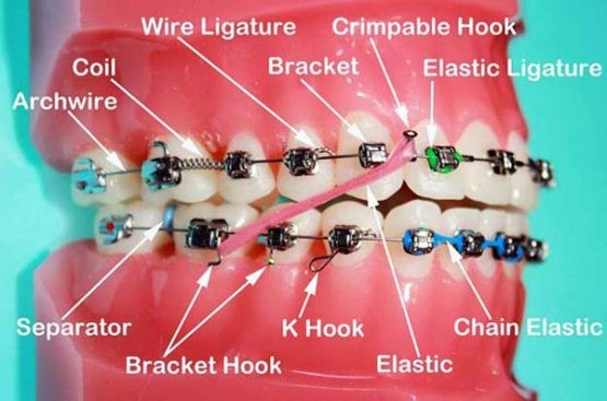 What to Know Before Getting Braces: The Complete Guide – Dreamworks ...