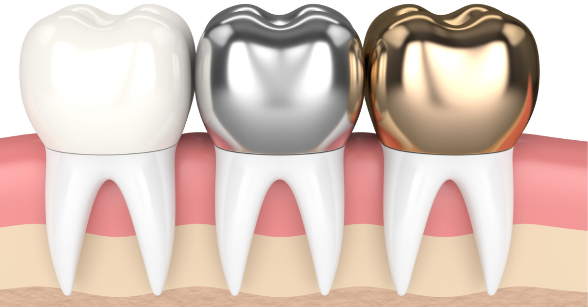 Types Of Dental Crowns And Cost Nhs at Annabelle Raggatt blog